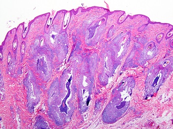 The Diagnosis of Fungal Kerion in Dogs