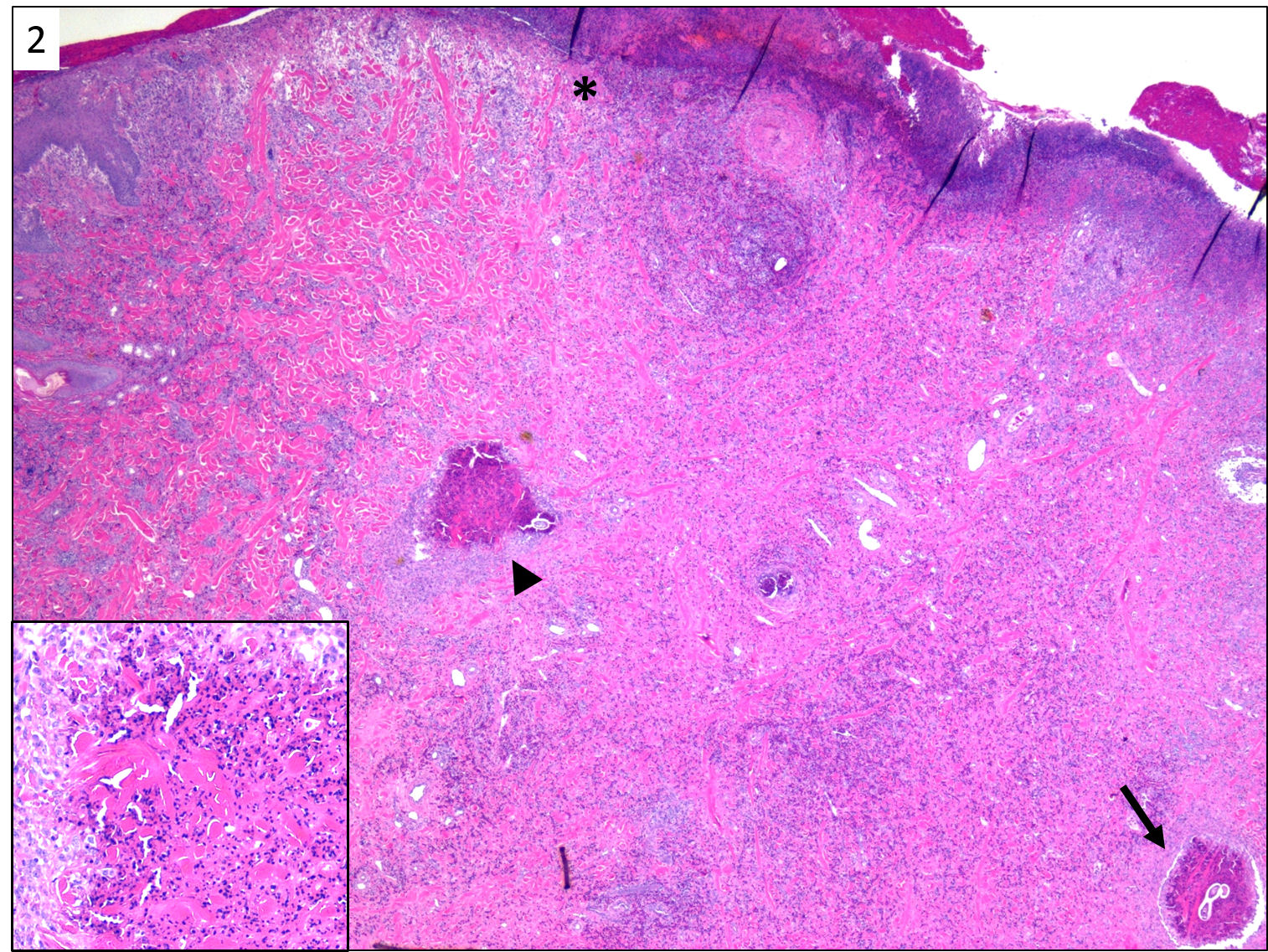 Cutaneous Habronemiasis in a Horse